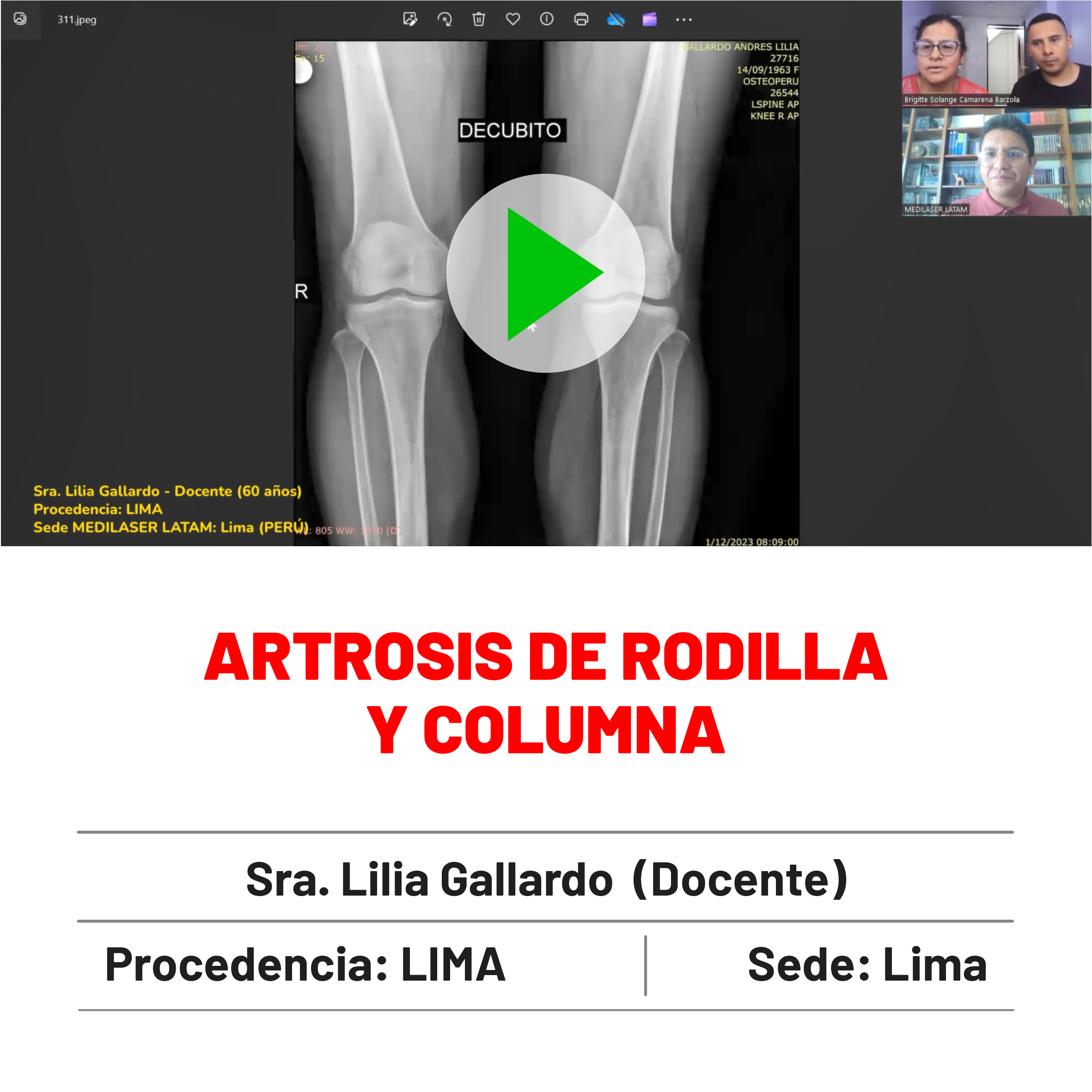 Artrosis de Rodilla y Columna | TESTIMONIO - Medilaser LATAM